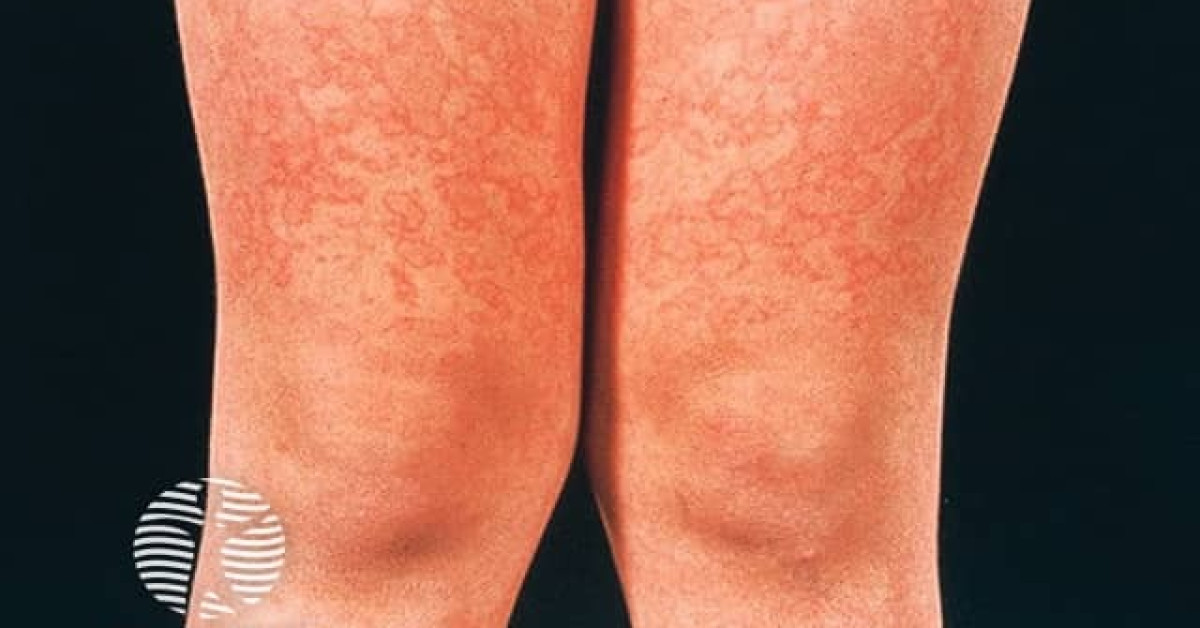 Erythema infectiosum image