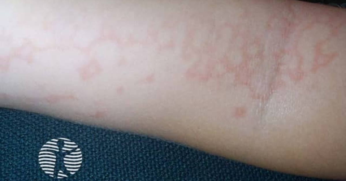 Erythema infectiosum image