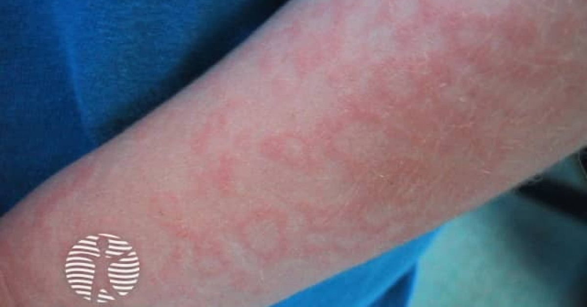 Erythema infectiosum image