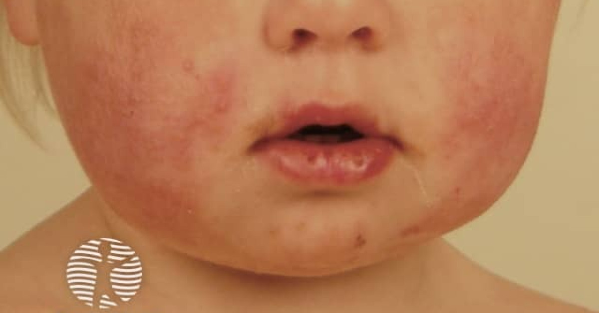 Gianotti-Crosti syndrome image