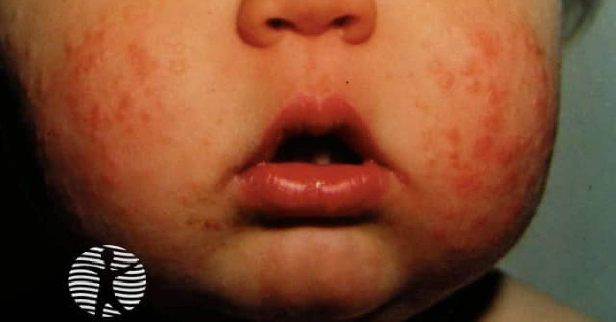 Gianotti-Crosti syndrome image