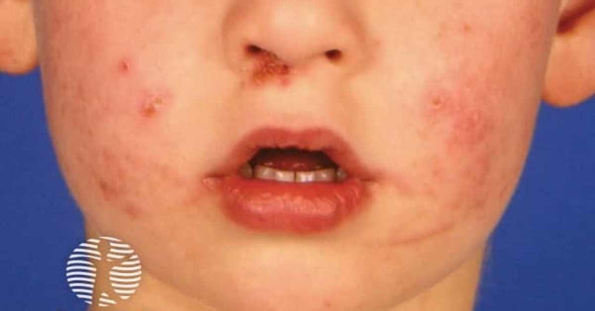 Gianotti-Crosti syndrome image