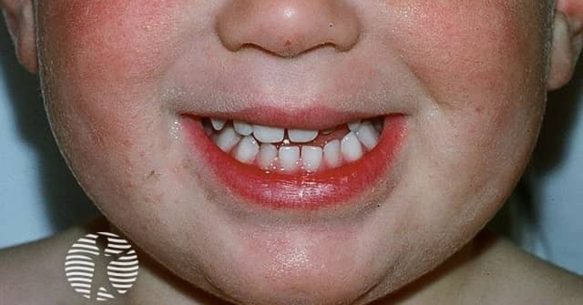 Gianotti-Crosti syndrome image