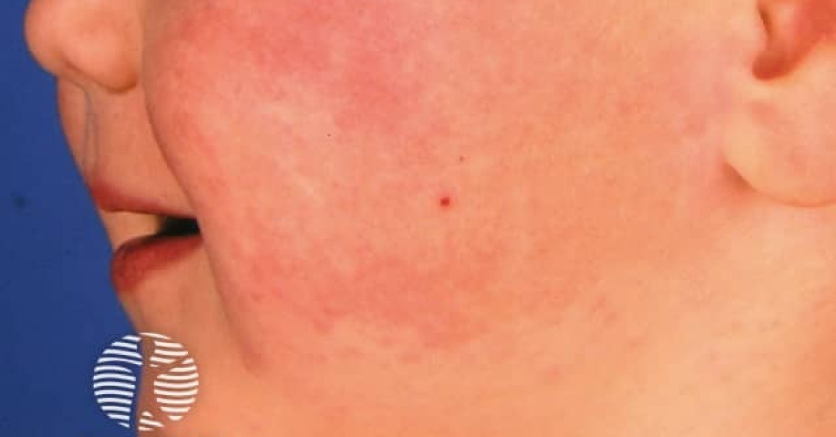 Gianotti-Crosti syndrome image