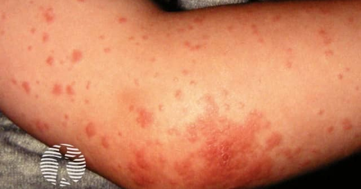 Gianotti-Crosti syndrome image