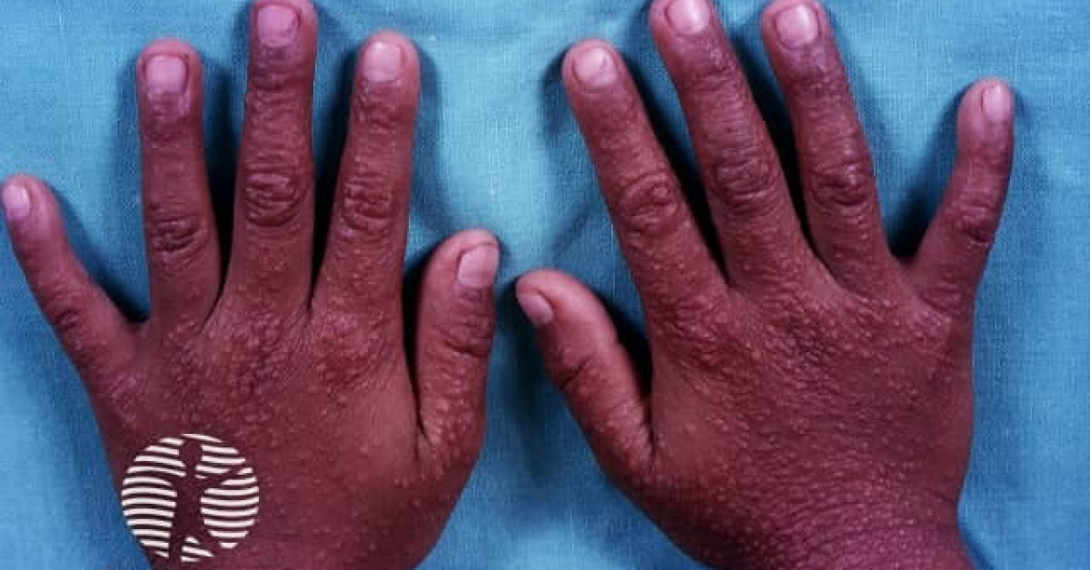 Gianotti-Crosti syndrome image