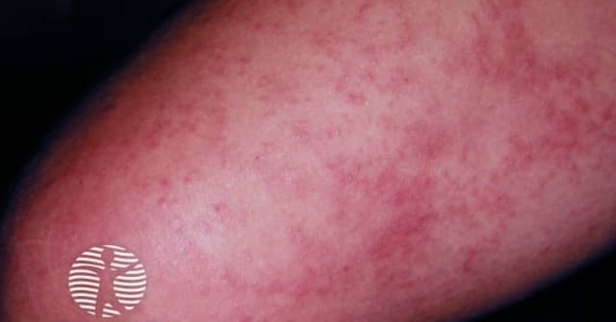 Gianotti-Crosti syndrome image