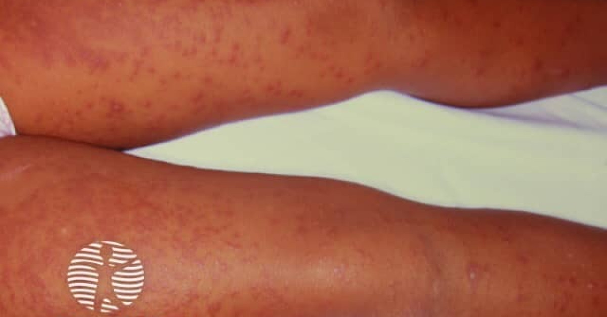 Gianotti-Crosti syndrome image