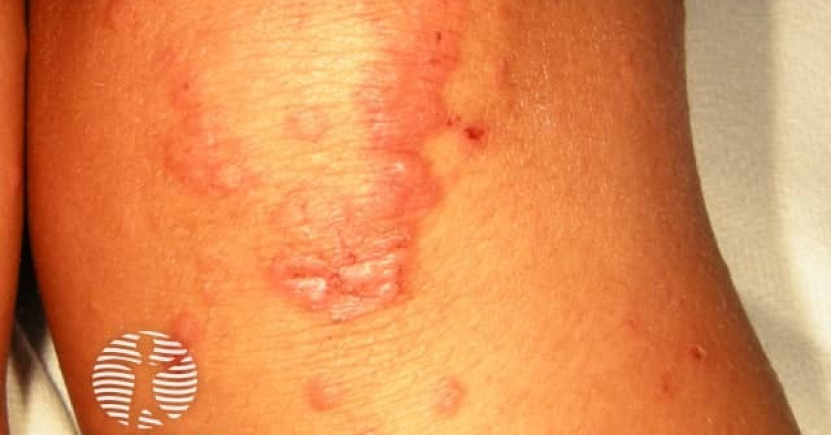 Gianotti-Crosti syndrome image