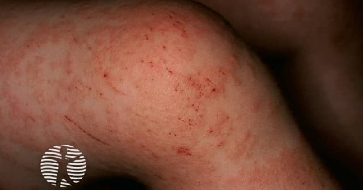 Gianotti-Crosti syndrome image