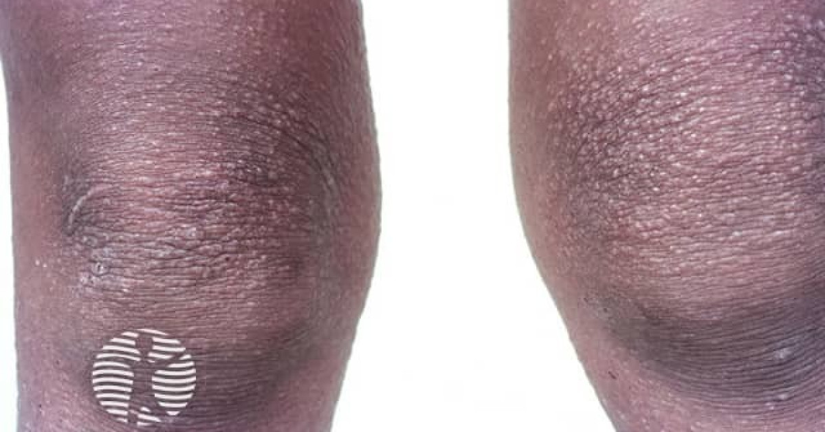 Gianotti-Crosti syndrome image