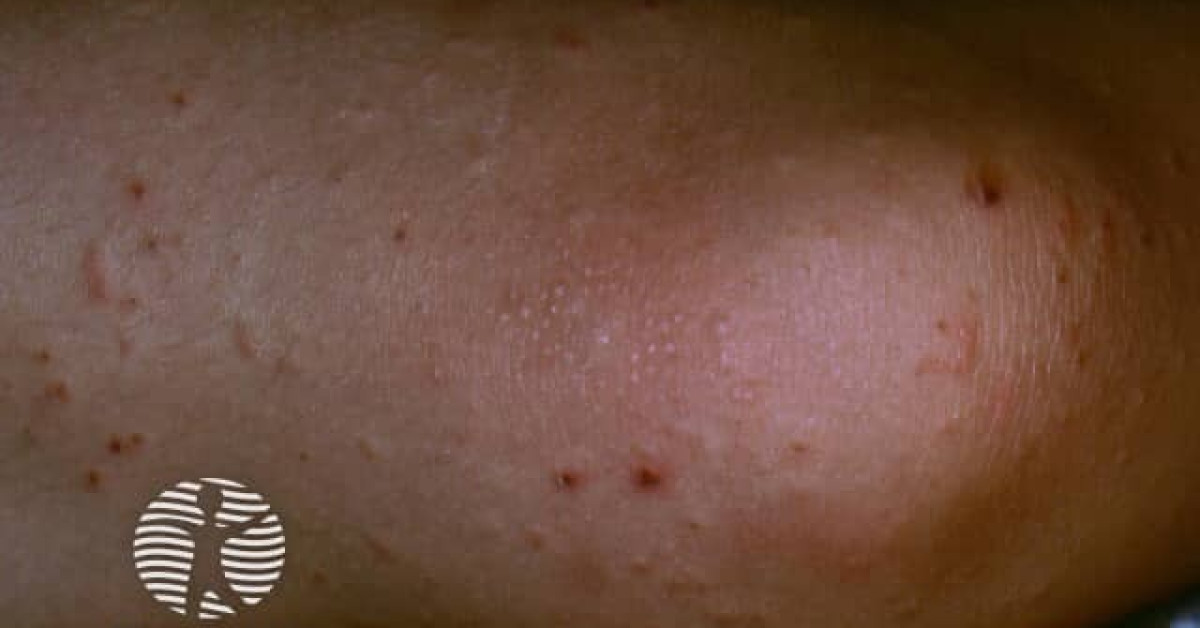 Gianotti-Crosti syndrome image