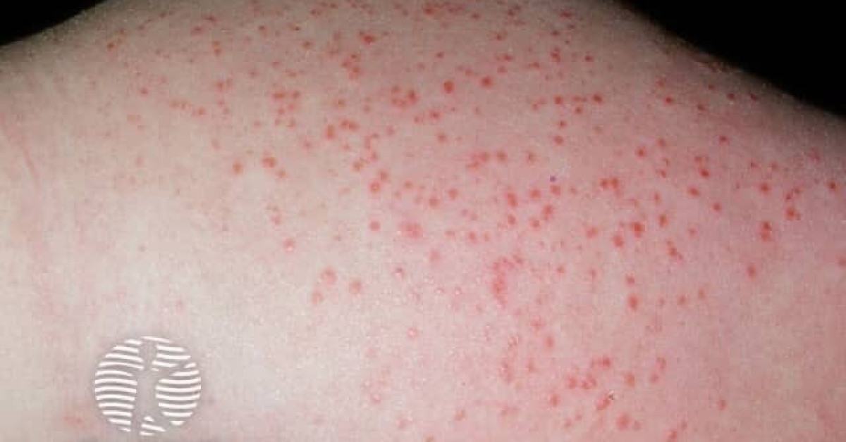 Gianotti-Crosti syndrome image