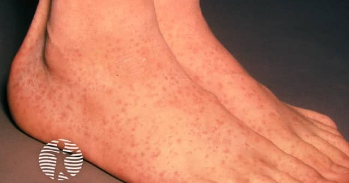 Gianotti-Crosti syndrome image