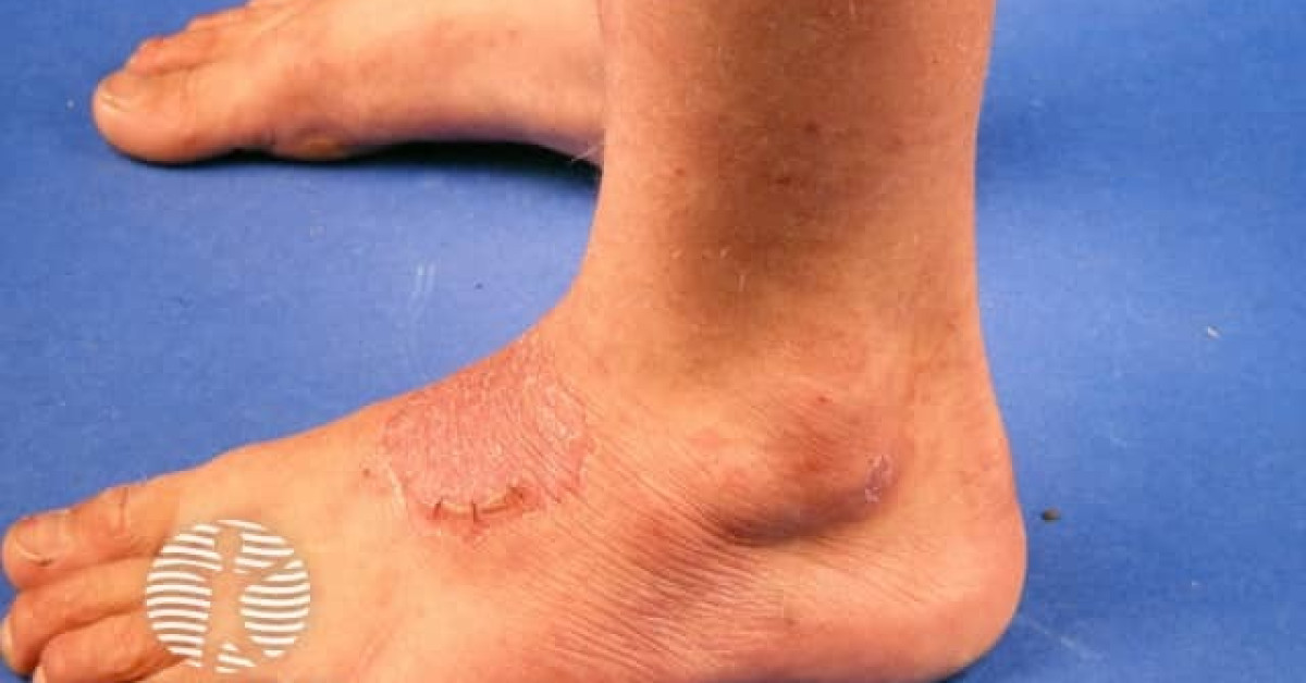 Gianotti-Crosti syndrome image