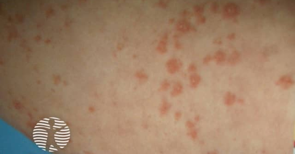 Gianotti-Crosti syndrome image