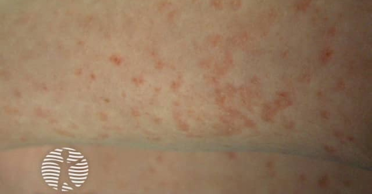 Gianotti-Crosti syndrome image