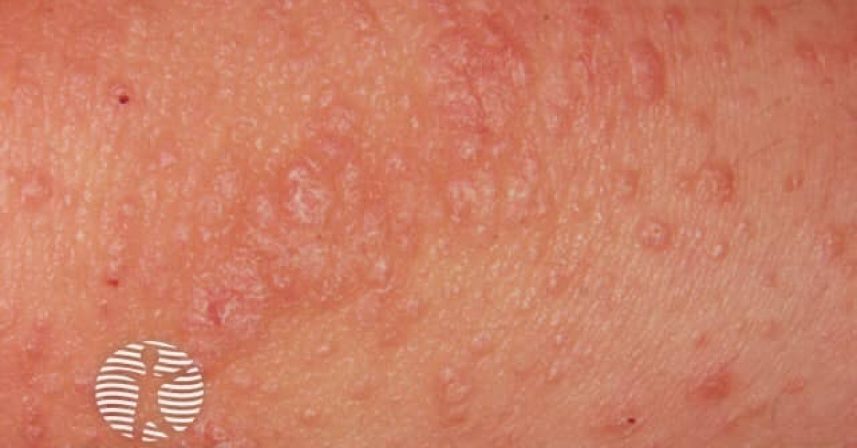 Gianotti-Crosti syndrome image