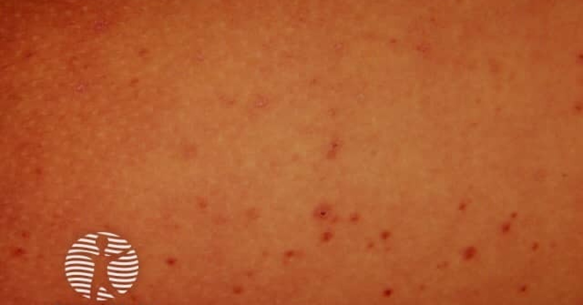 Gianotti-Crosti syndrome image