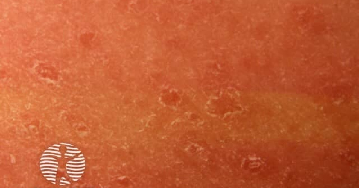 Gianotti-Crosti syndrome image
