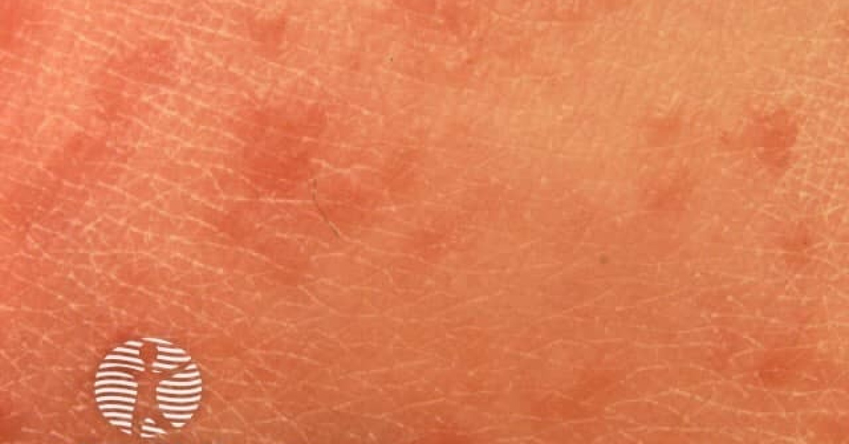 Gianotti-Crosti syndrome image