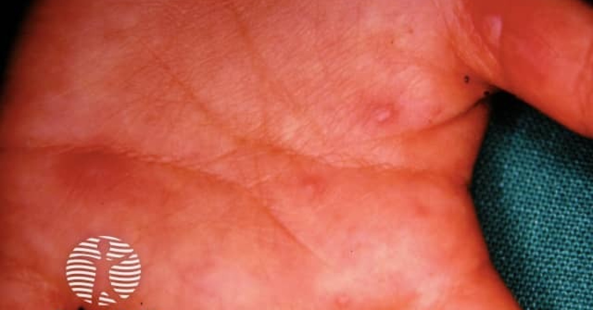 Hand foot and mouth disease image