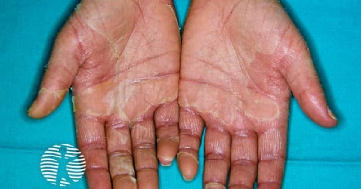 Measles image
