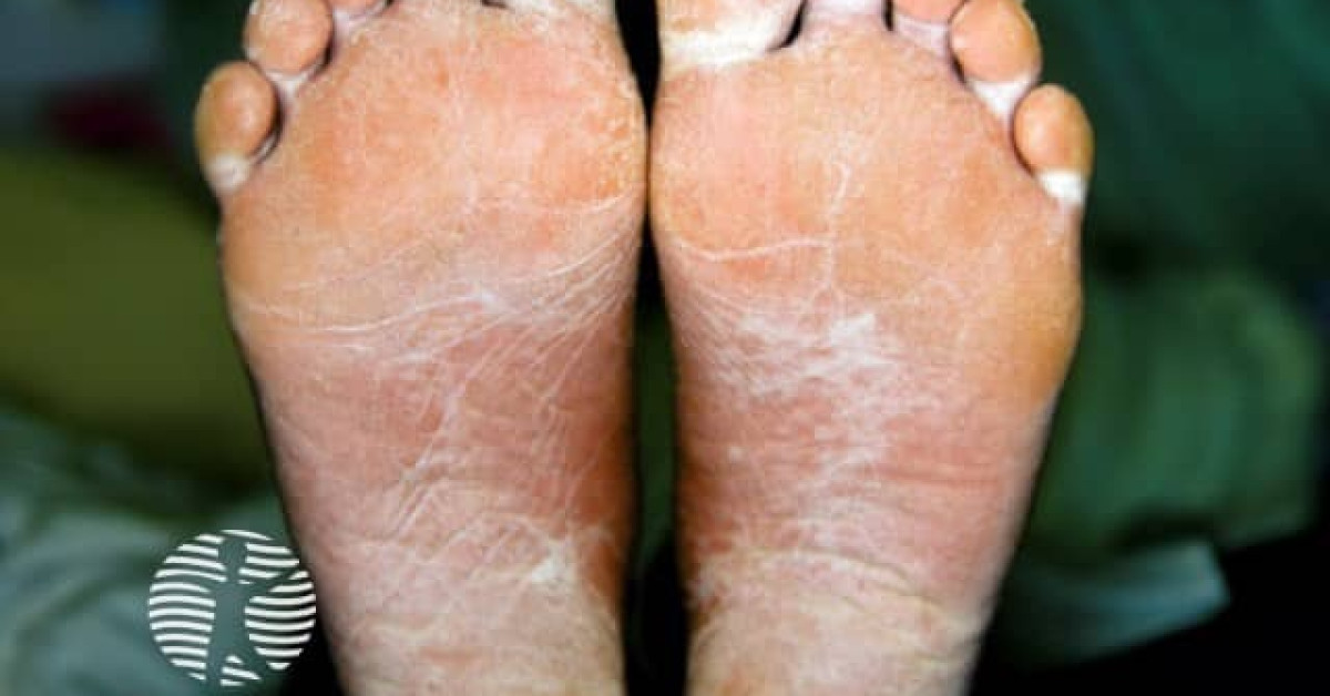 DermNet® - Measles image