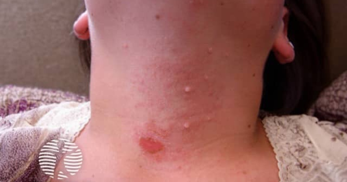 Molluscum contagiosum image