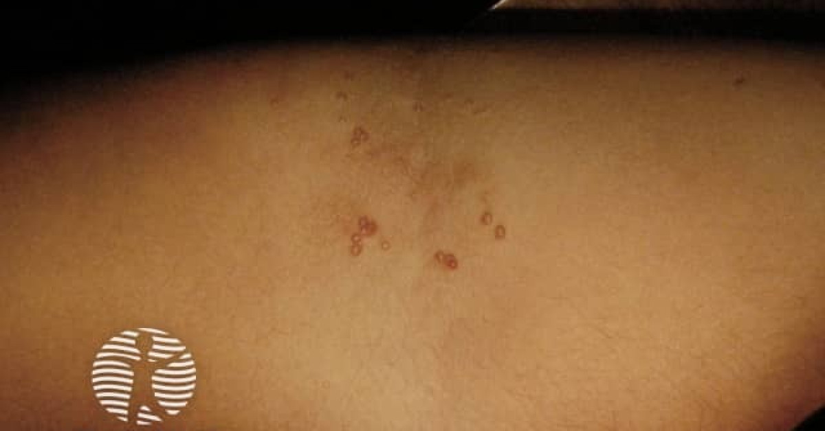 Molluscum contagiosum image