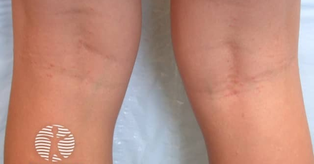 Molluscum contagiosum image