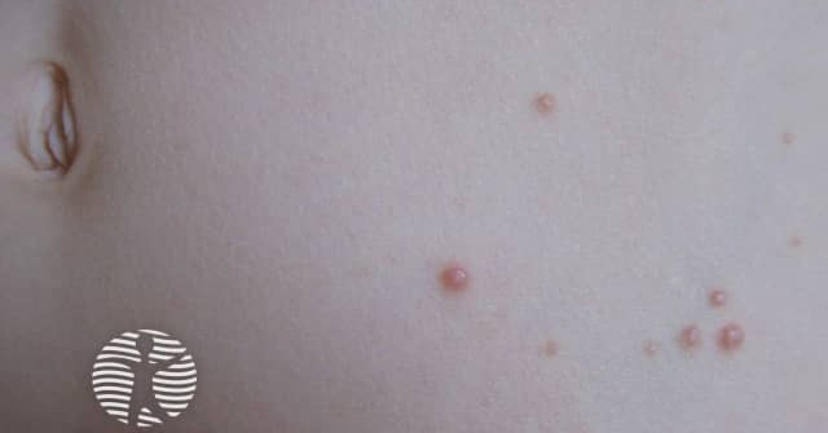 Molluscum contagiosum image