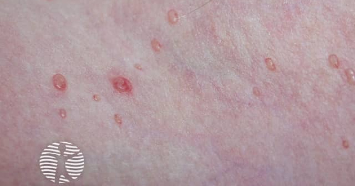 Molluscum contagiosum image