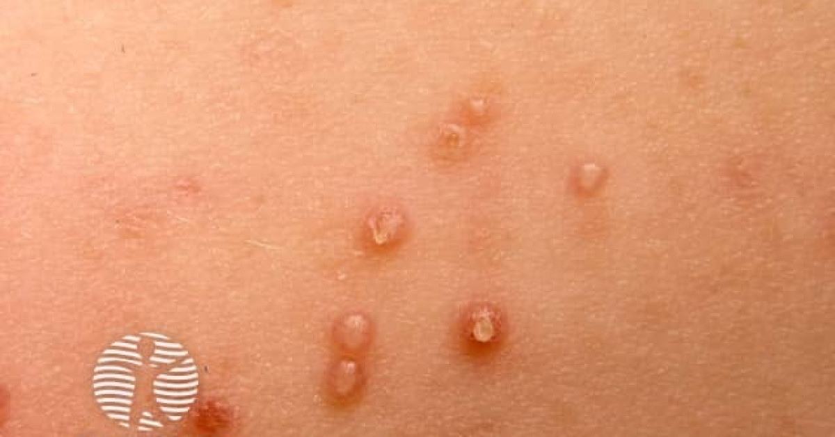 Molluscum contagiosum image