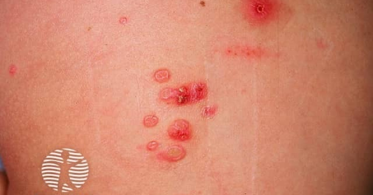 Molluscum contagiosum image
