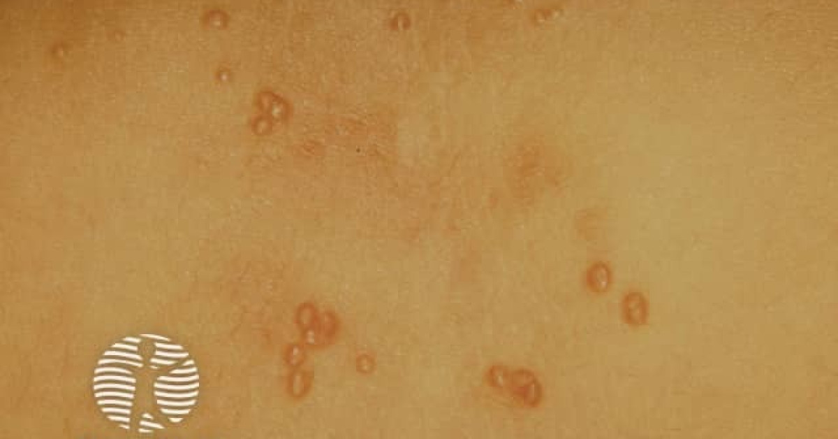 Molluscum contagiosum image