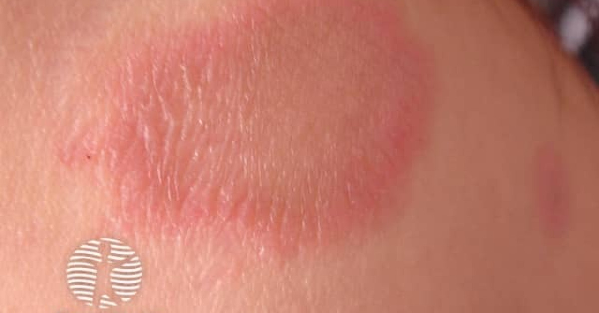 Pityriasis rosea image