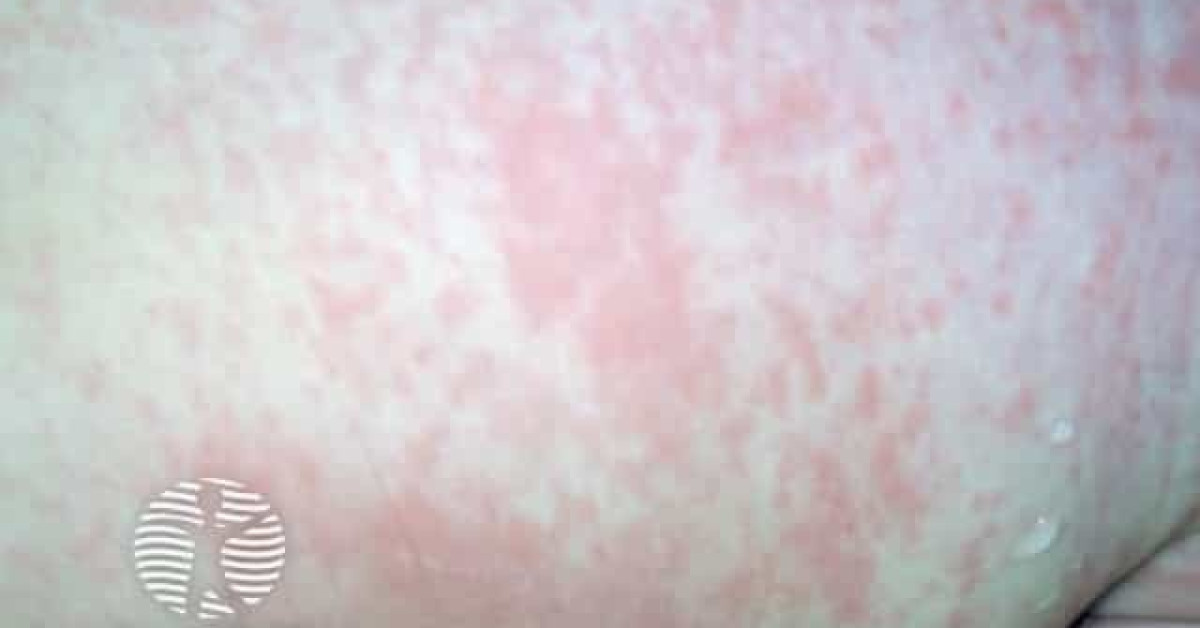 Rubella rash image