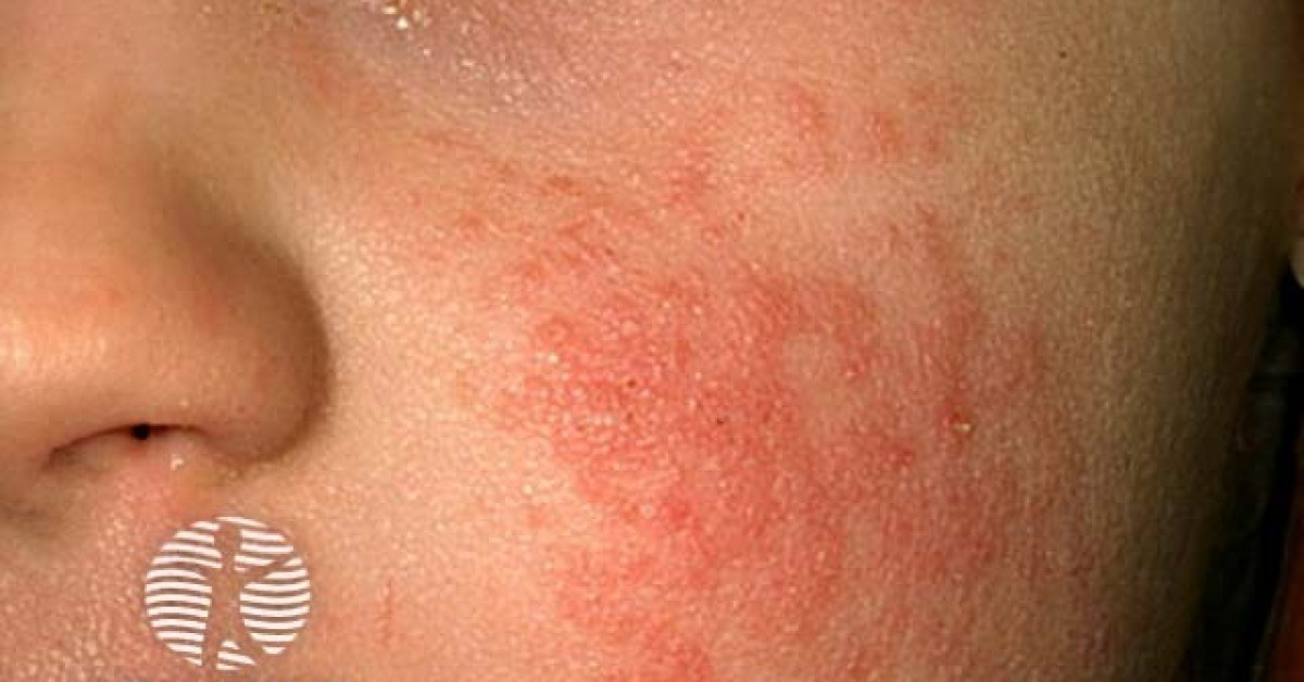 Gianotti-Crosti syndrome image
