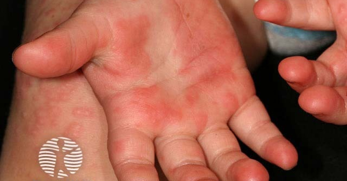 Gianotti-Crosti syndrome image