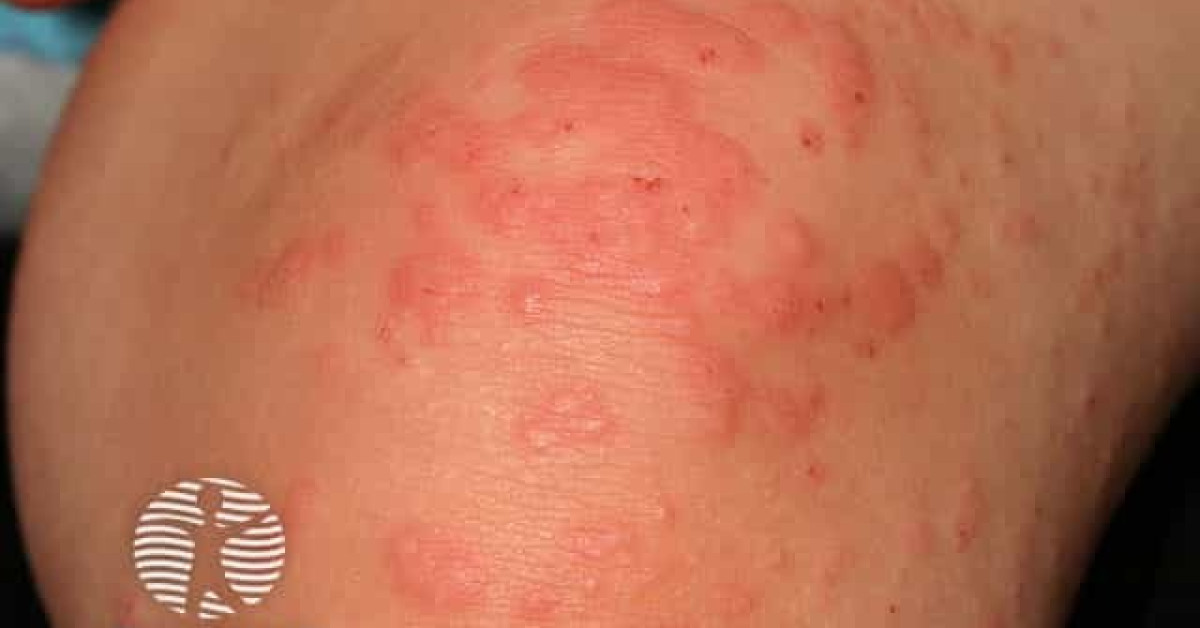 Gianotti-Crosti syndrome image