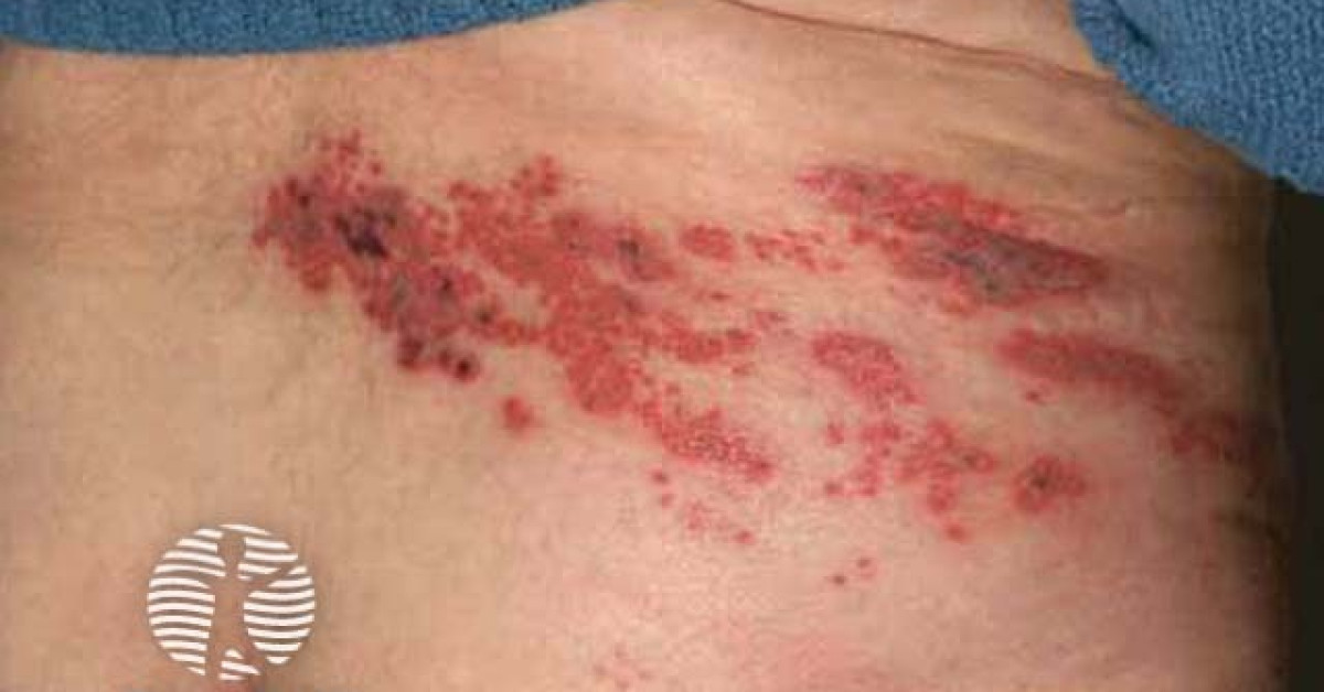 Herpes Zoster image