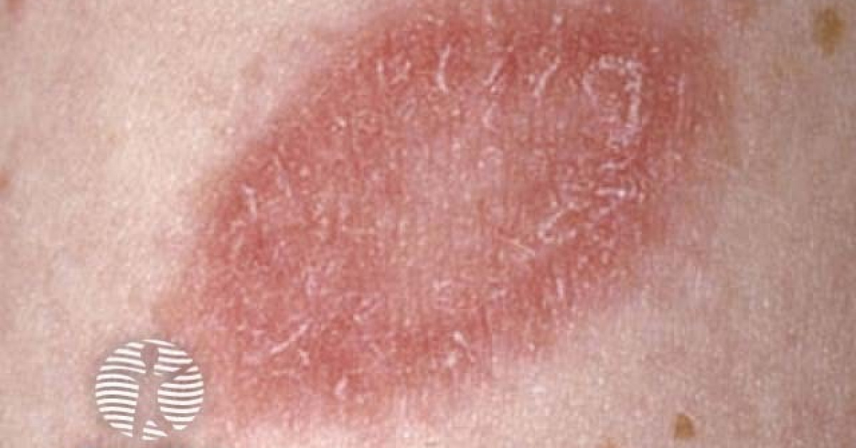 Pityriasis rosea image
