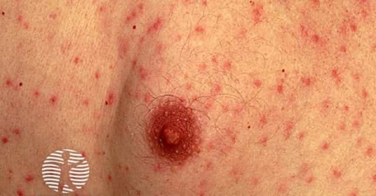 Chickenpox image