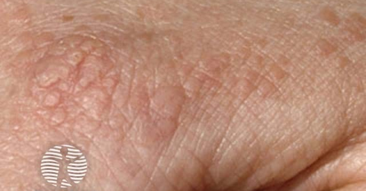 Viral warts image