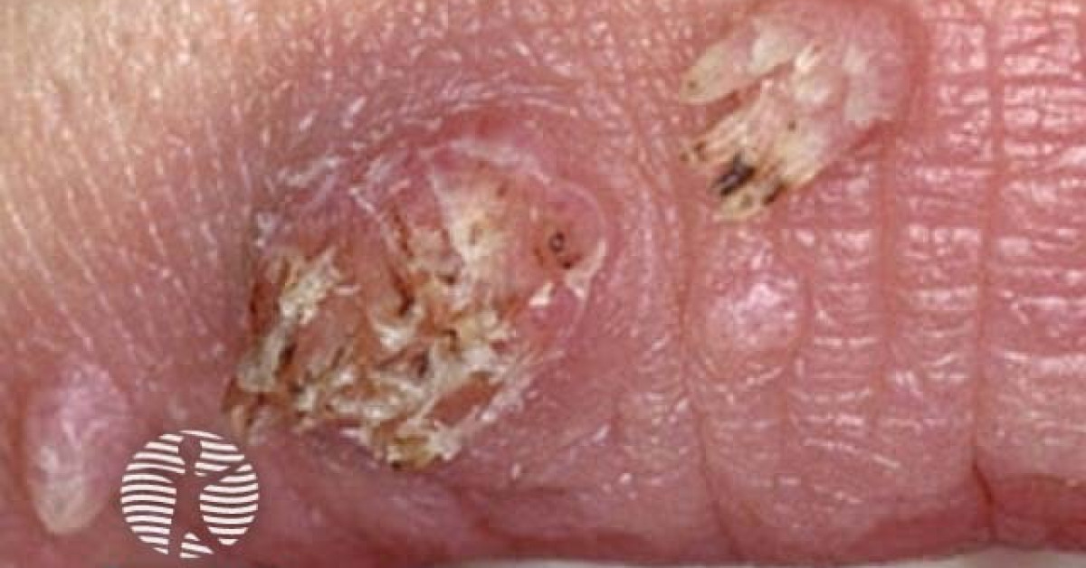 Viral warts image