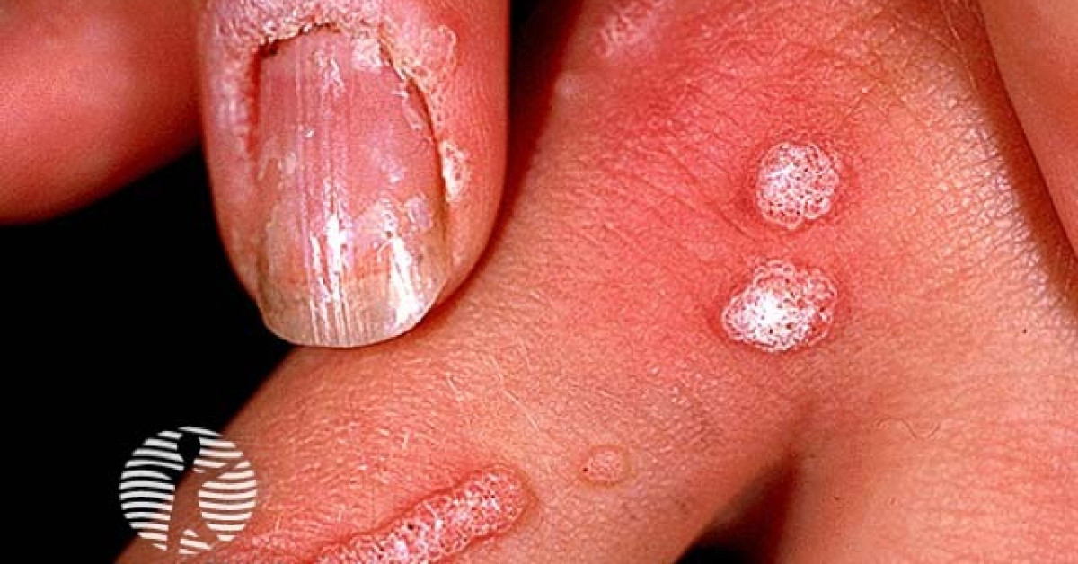 Viral warts image