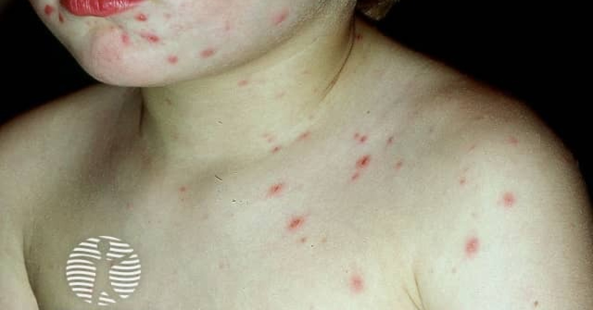 Chickenpox image