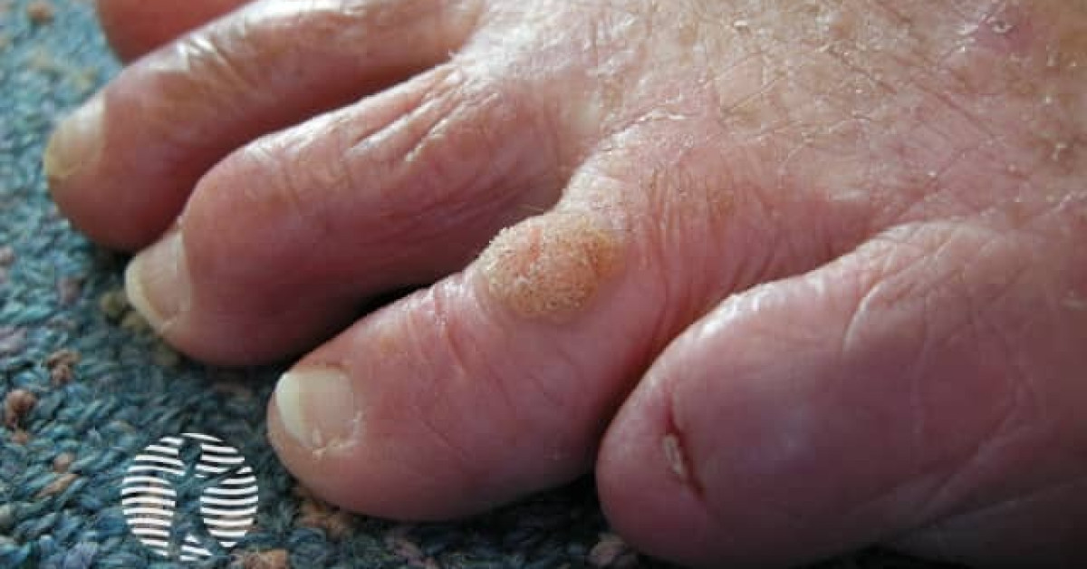 Viral warts image