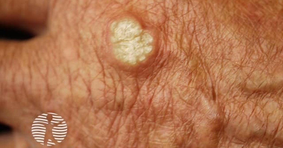 Viral warts image